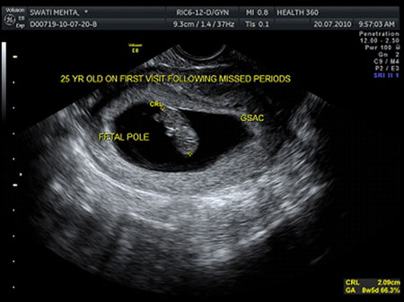 Atlas of ultrasound images during early pregnancy