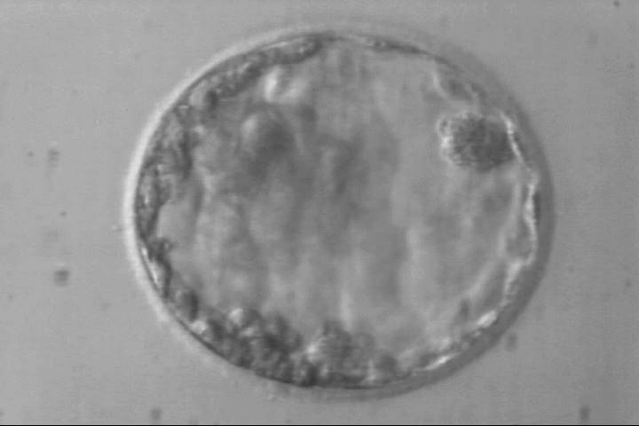 Embryos - An atlas for IVF patients | Malpani Infertility Clinic, Mumbai