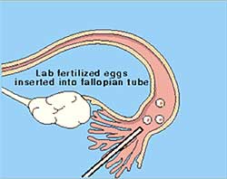 A complete guide of Gamete Intrafallopian Transfer (GIFT) and zygote ...