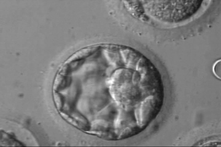 Embryos - An atlas for IVF patients | Malpani Infertility Clinic, Mumbai